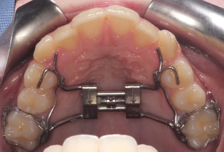 Palatal Expanders: Why, How, and When | Orthodontist Vaughan | Braces ...