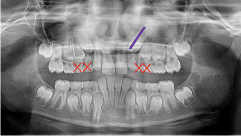 Early Extraction of Upper Baby Canines | Orthodontist Vaughan | Braces ...